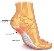 Hielspoor en Fasciitis